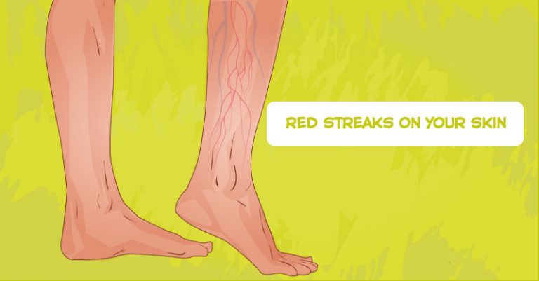 How To Recognize A Blood Clot: 6 Tell-Tale Symptoms - us.abrozzi.com